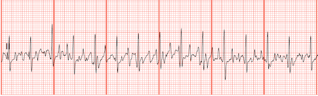 Basic EKG Rhythm Test 40
