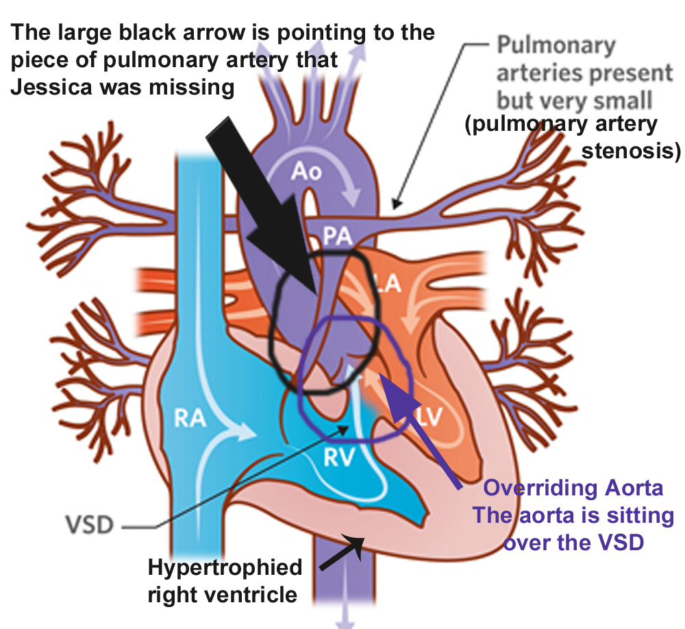 Are We Having Fun Yet?: Tetralogy of Fallot with Pulmonary Atresia ...