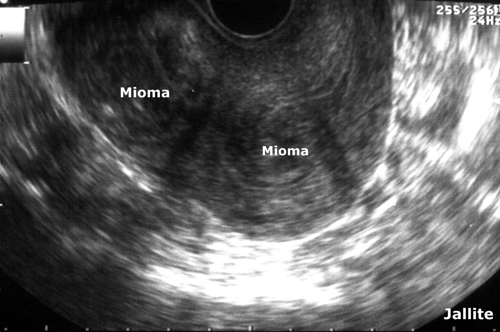 Miomatosis Uterina Degenerativa