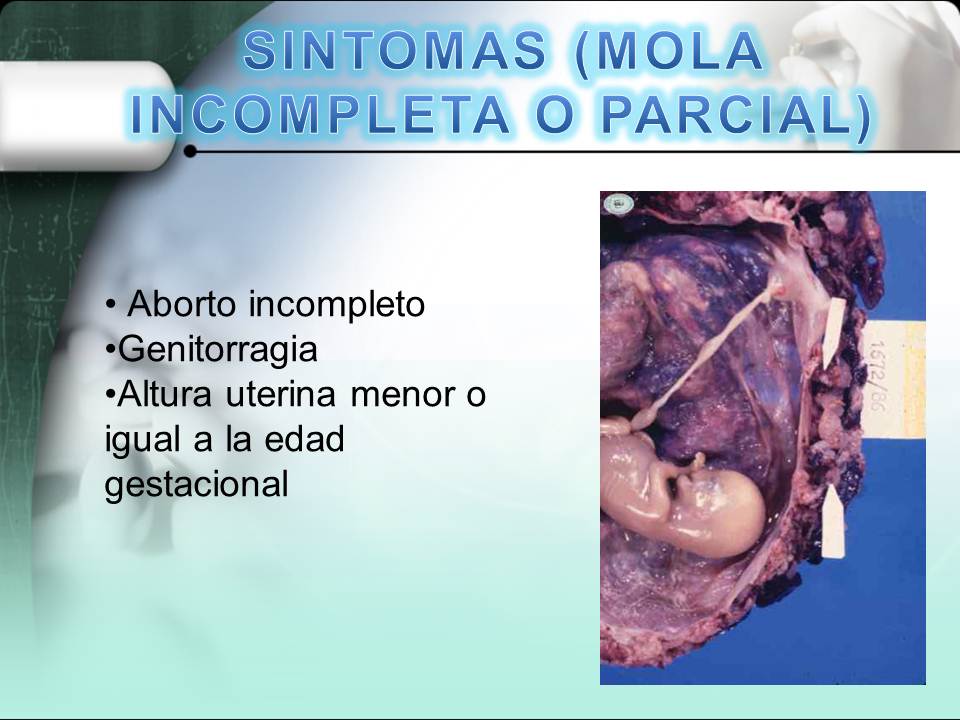 embarazo molar