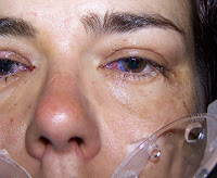 Sculpted Windows Jewelry Journal: 2 Days After Eye Surgery....