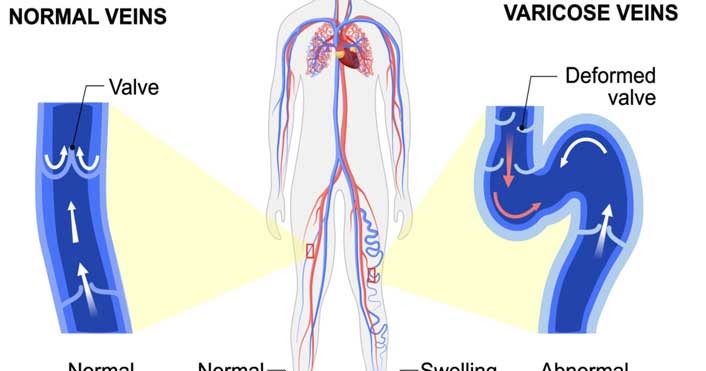 Prostate Enlargment Treatment without Surgery: Symptoms of Varicose ...