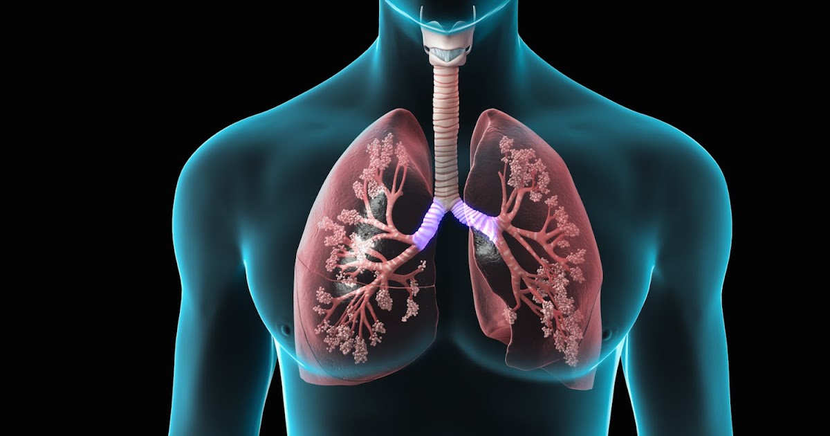 PNEUMONIA: symptoms, causes and classification.