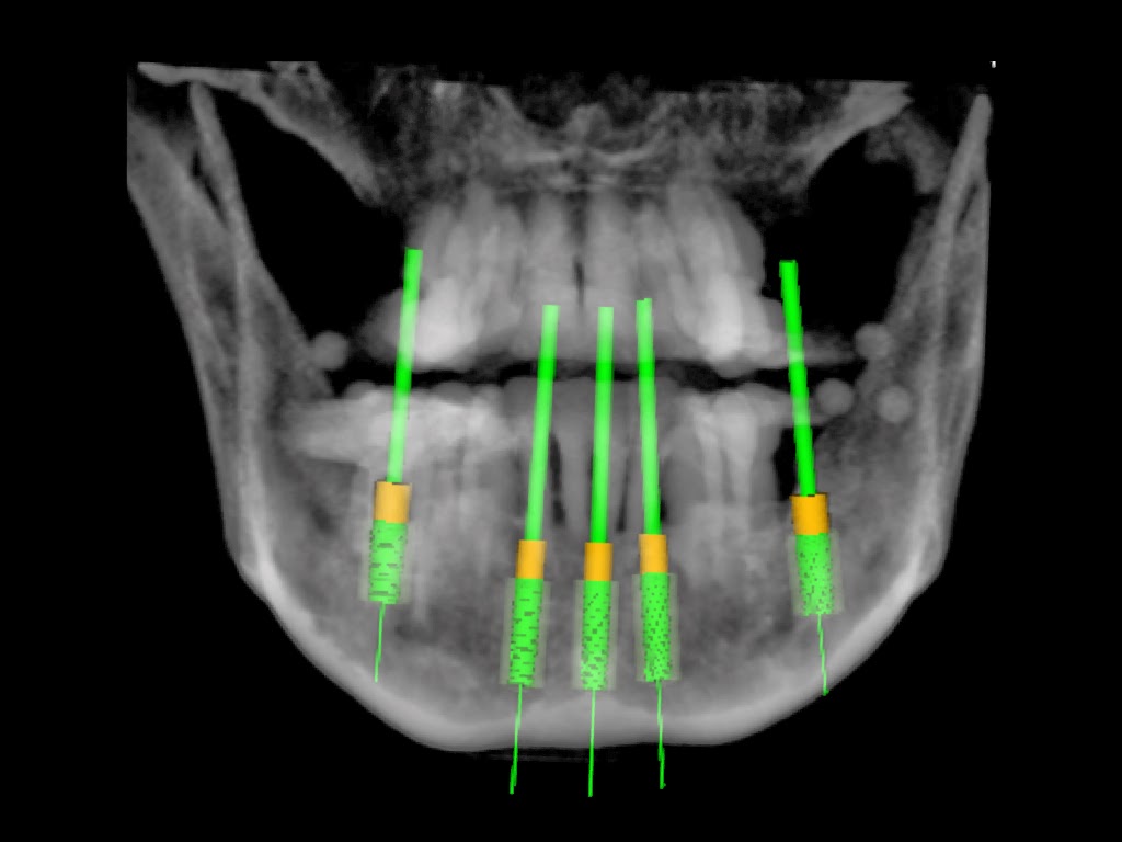 Boise Idaho Prosthodontics: Immediate Load Implant Prosthesis - Hybrid