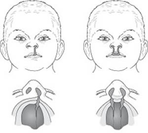 Labio Leporino e Fenda Palatina: Labio Leporino e Fenda Palatina