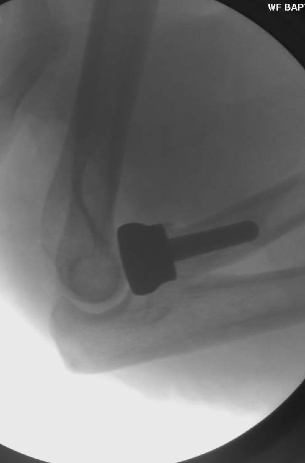 Shoulder and Elbow Surgery: Terrible triad injury. The importance of ...