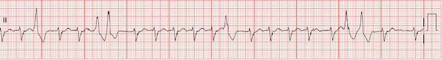 EKG Rhythm Strips 56: Atrial Fibrillation