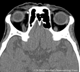 Dr Balaji Anvekar FRCR: Calcification of trochlear apparatus of orbit
