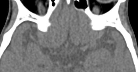 Dr Balaji Anvekar FRCR: Calcification of trochlear apparatus of orbit