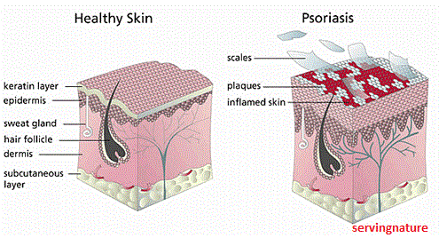 Healthy Body-Healthy Mind: Skin Disorder-Psoriasis