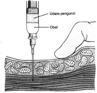 SOP Injeksi Intramuscular (IM) ~ Ns. RIO CRISTIANTO