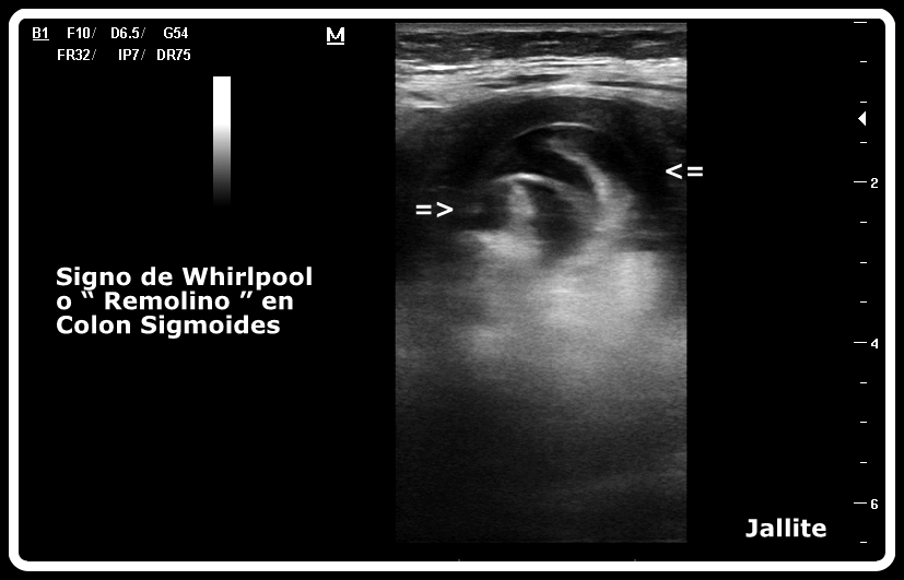 Signo del Whirlpool o del Remolino