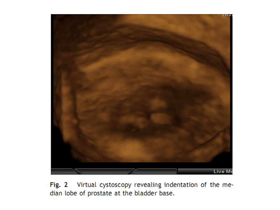 BÀI SOẠN VỀ SIÊU ÂM CHẨN ĐOÁN: VIRTUAL CYSTOSCOPY USING 3D ULTRASOUND
