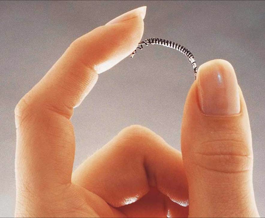 Ventajas de la anticoncepción con Essure | Blog inicial de Angela Arias ...