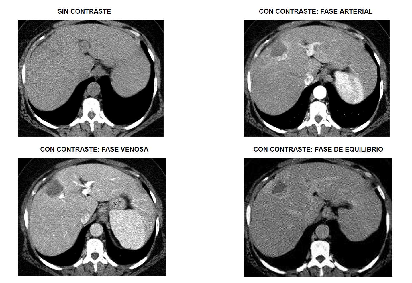 DIAGNÓSTICO DEL CÁNCER DE HÍGADO