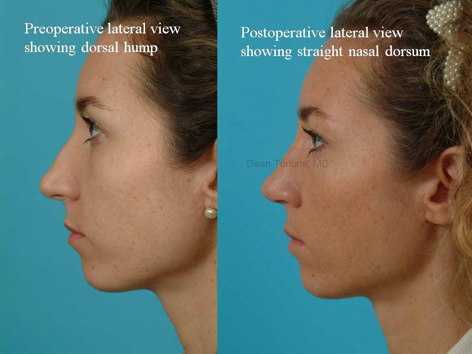 Dr. Dean Toriumi Reviews: Dean Toriumi Reviews: Primary rhinoplasty ...