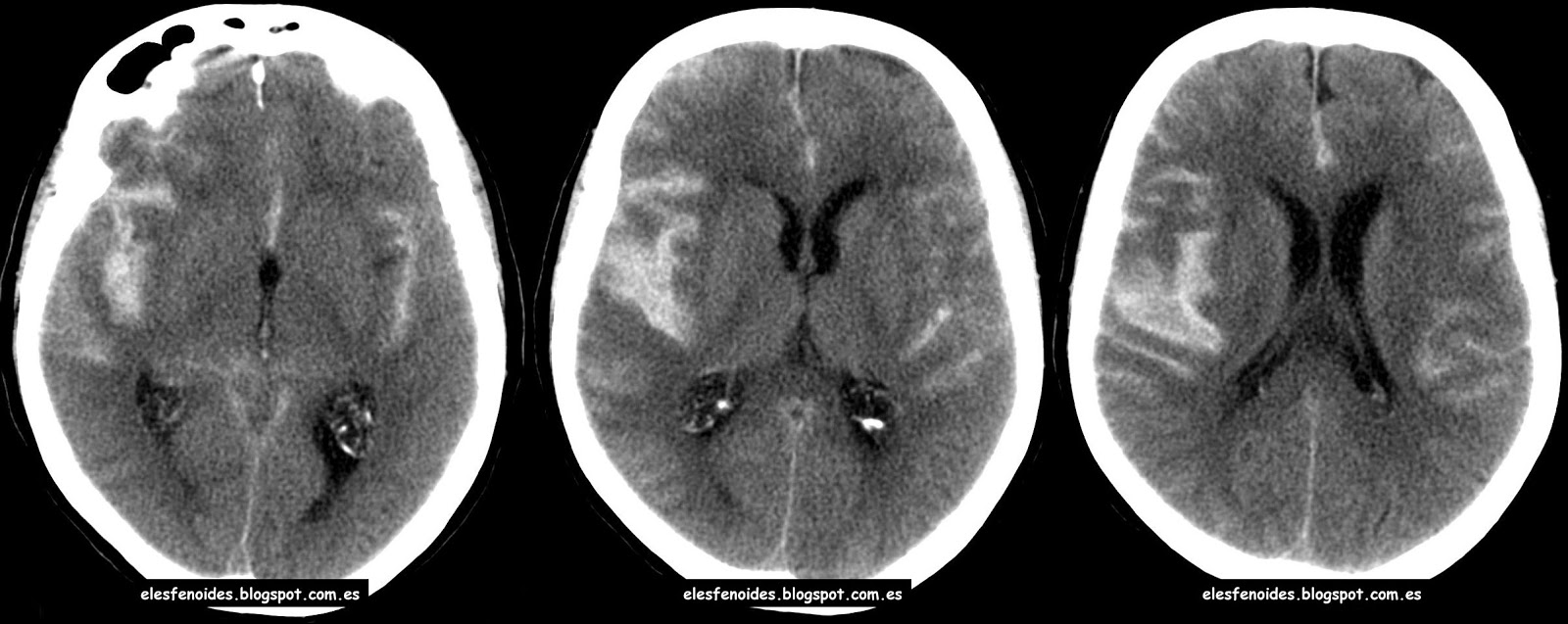 El esfenoides: Hemorragia subaracnoidea. 2 imágenes 1 caso.