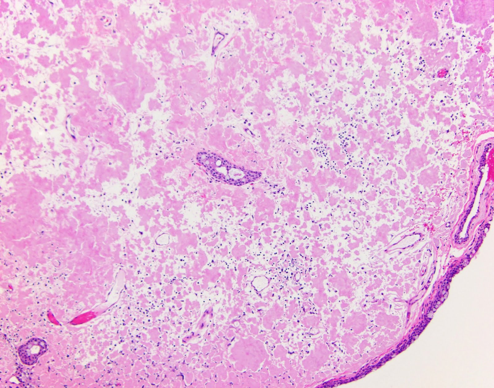 neuropathology blog: A case of recurrent ligneous conjunctivitis in an ...