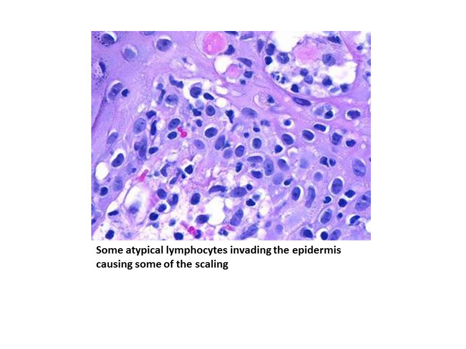 Consultations in Dermatology: Pityriasis Lichenoides PLEVA