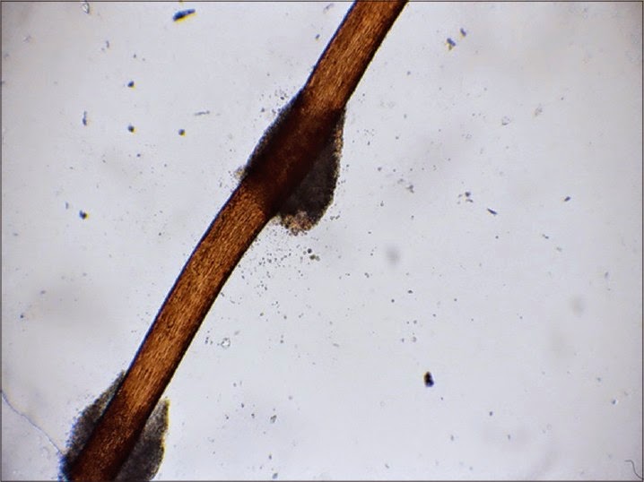 Teledermatology for PG entrance: Common Hair shaft infections