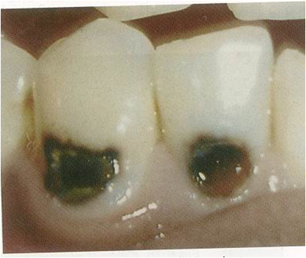 Dentistry and Medicine: Dental Caries definition, Classification of ...