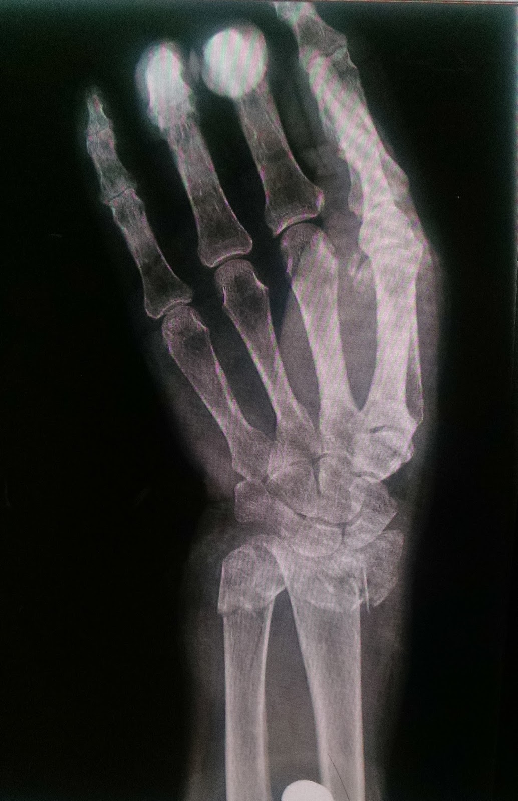 O R T O C R I T I C A: Fractura de radio distal