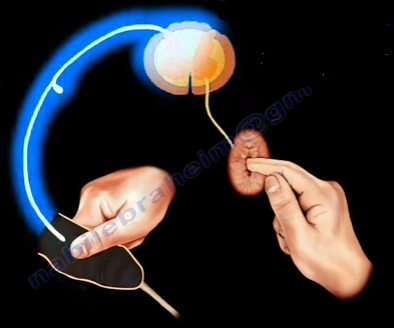 Dr. Nabil Ebraheim's Blogspot: Bulbocavernosus Reflex and Spinal Shock