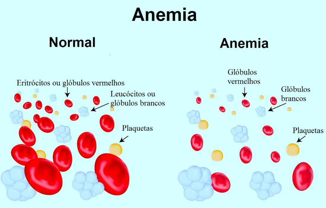 Ask Kidney Doctor: Anemia and chronic kidney disease