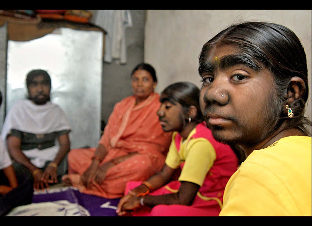Three "Werewolf" Sisters from India : Suffering from Werewolf Syndrome ...