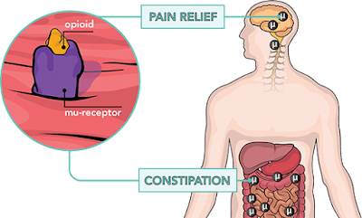 Opioid Induced Constipation Market Analysis, Demand, Growth ...