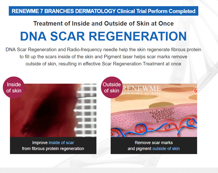 Renewme Skin Clinic: DNA scar regeneration treatment review