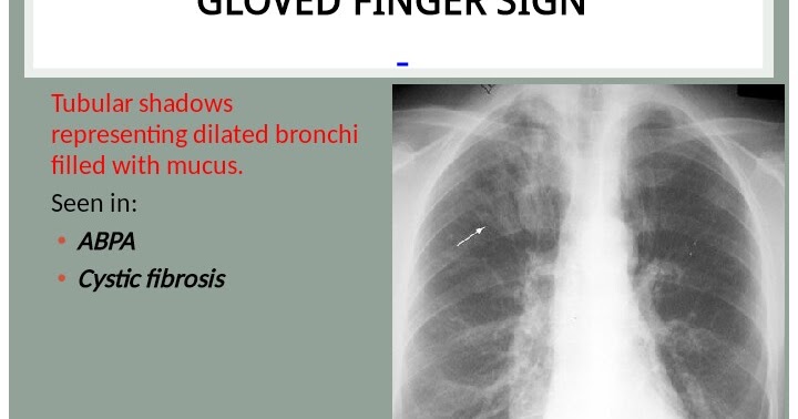 Chest Medicine Made Easy-Dr Deepu: Gloved finger sign