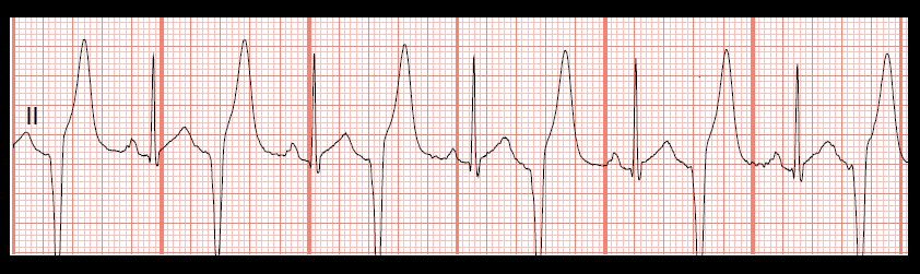 Various Bigeminal PVCs