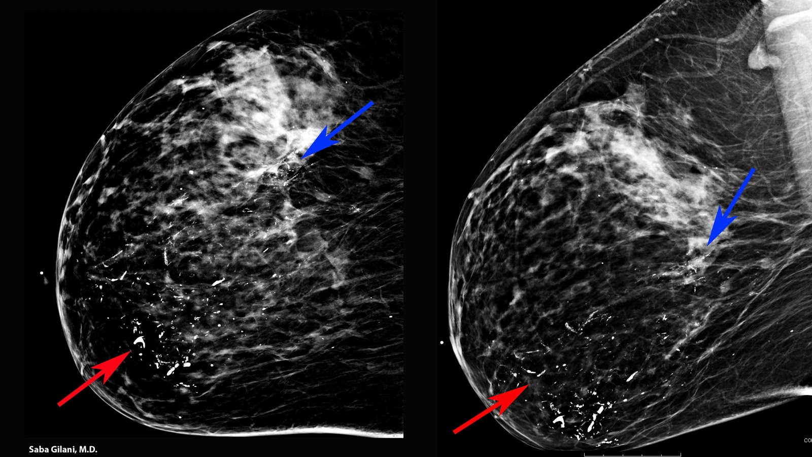 Roentgen Ray Reader: Secretory Calcifications