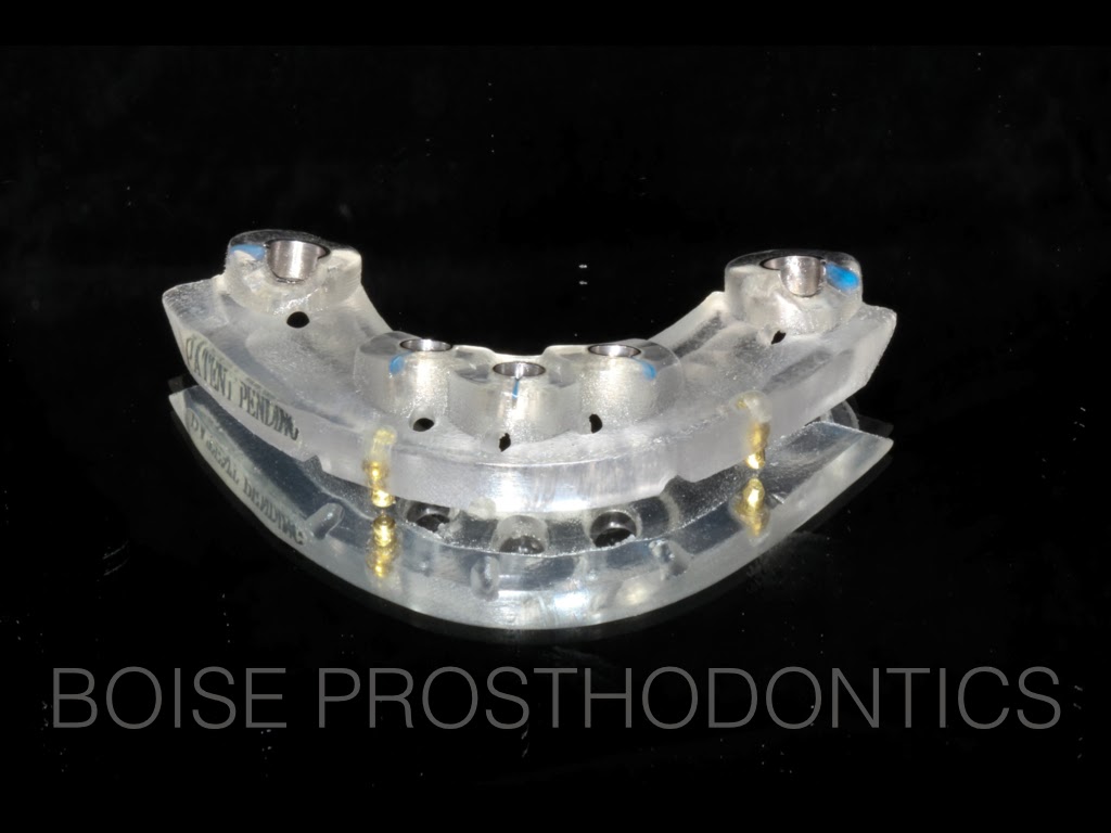 Boise Idaho Prosthodontics: Immediate Load Implant Prosthesis - Hybrid
