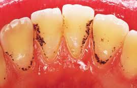 Bem vindo ao meu consultório Virtual!!!: Sabe o que é Bactéria Cromogênica?