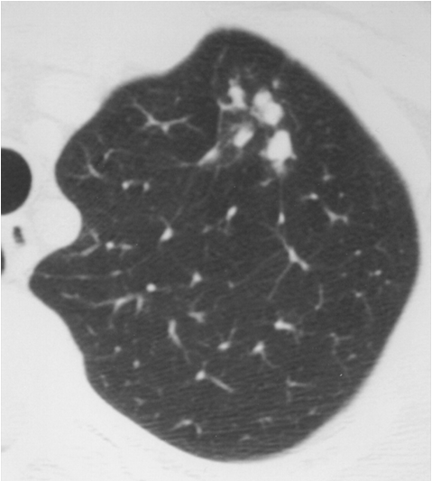 Chest Medicine Made Easy-Dr Deepu: The HRCT findings of Bronchiectasis.