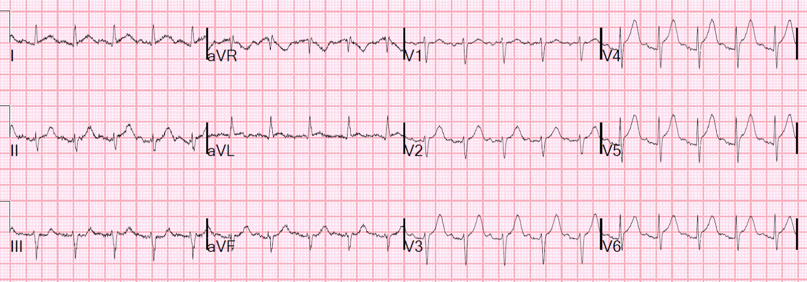 Normal Lv Size With Hyperdynamic Systolic Function | semashow.com