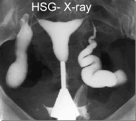 Teknik Pemeriksaan Radiografi Histerosalpingografi (HSG) ~ Bocah ...