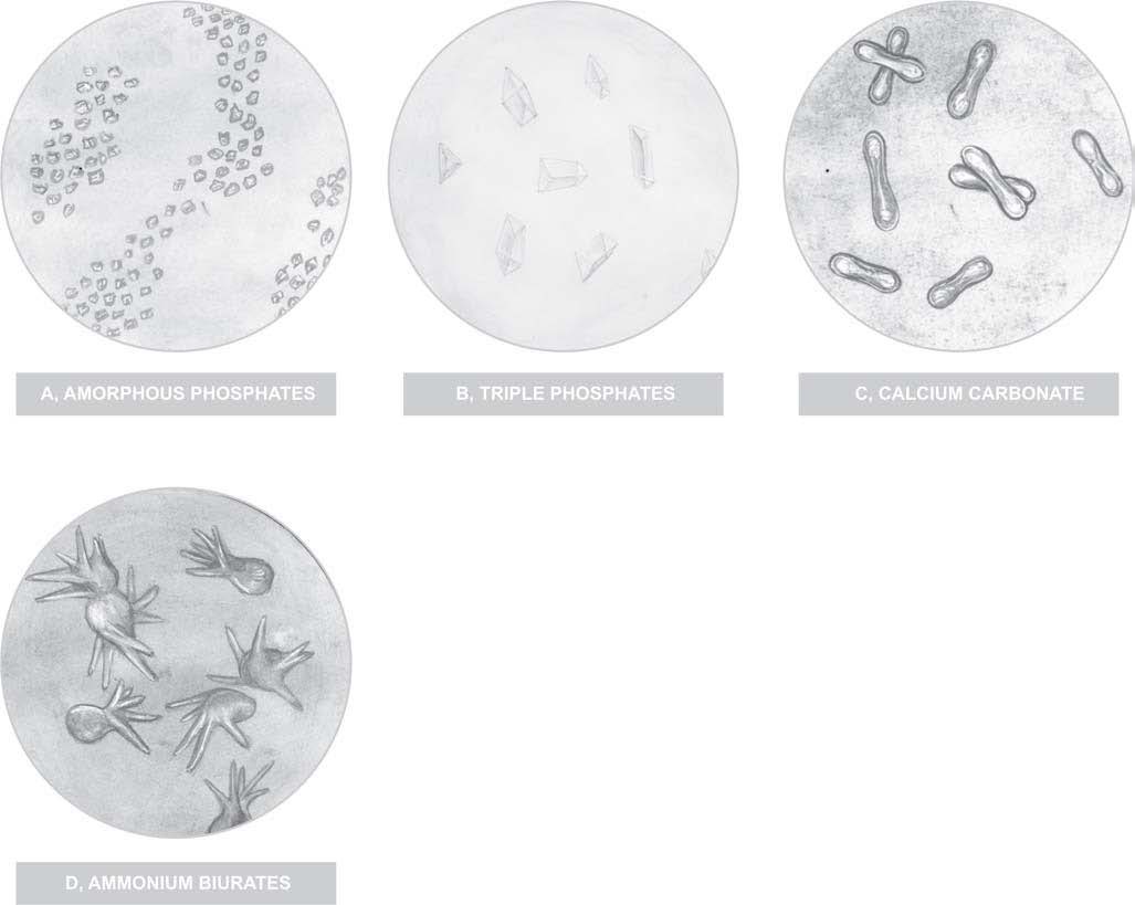 Crystals in Urine: Alkaline Urine