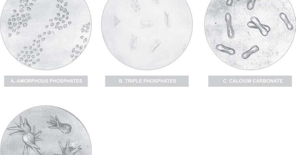 Crystals in Urine: Alkaline Urine