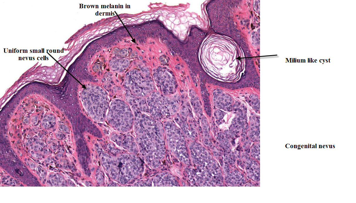 Congenital Melanocytic Nevus Histology