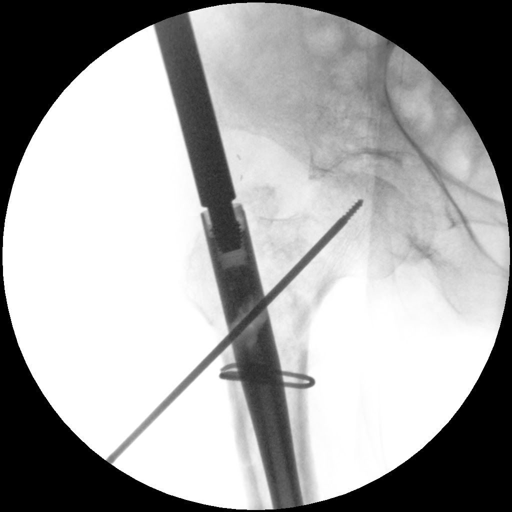 Diario De Practicas: CLAVO ENDOMEDULAR DE FÉMUR CON IJNERTO DE HUESO