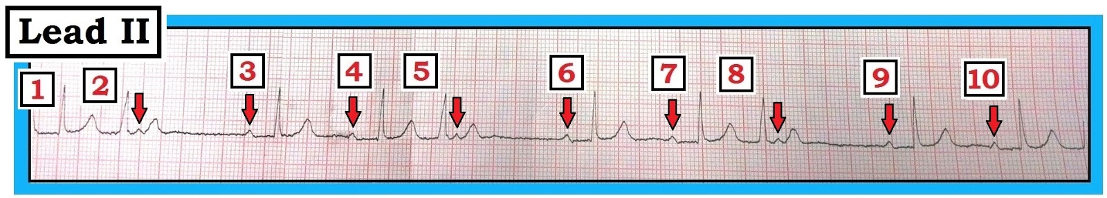 ECG Interpretation: ECG Blog #69 (Laddergrams – Group Beating)
