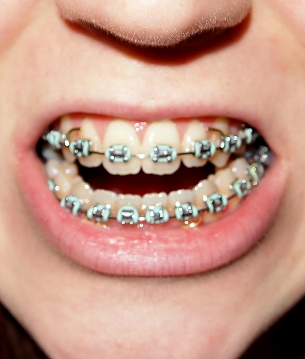 Rosa's Jaw Surgery Story: Current teeth update