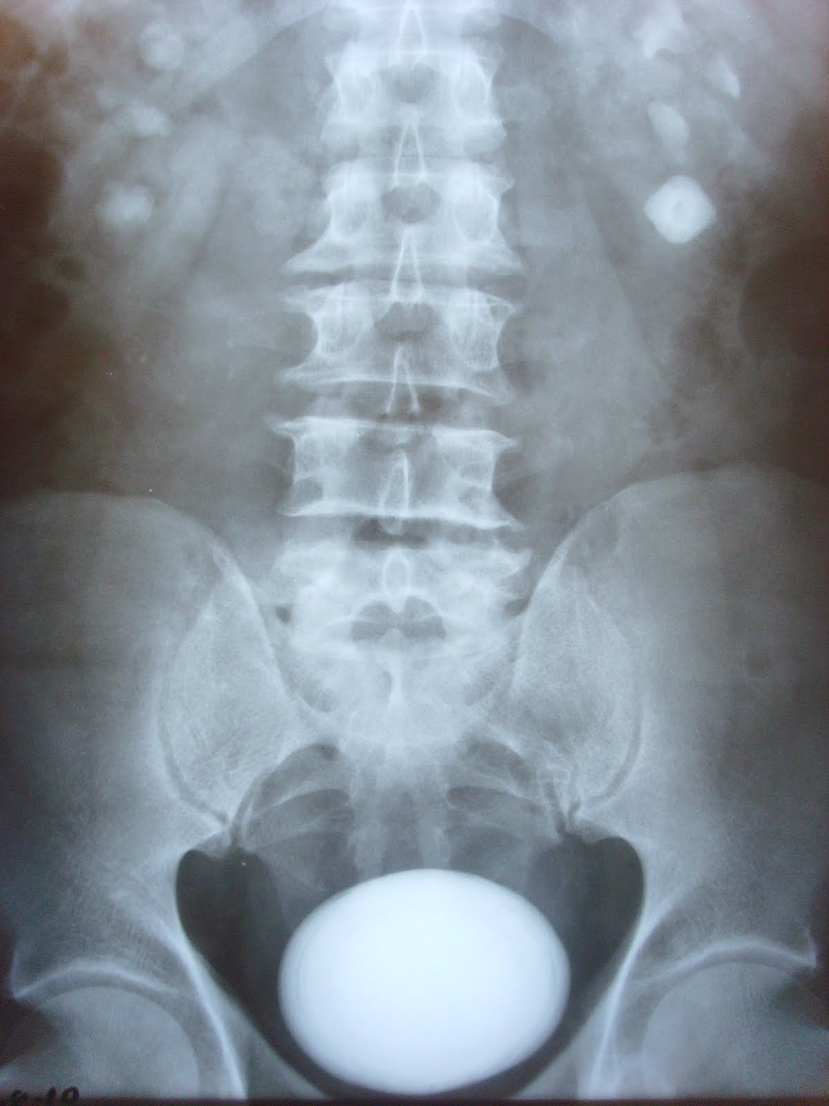 ATENCION PRIMARIA: LITIASIS URINARIA