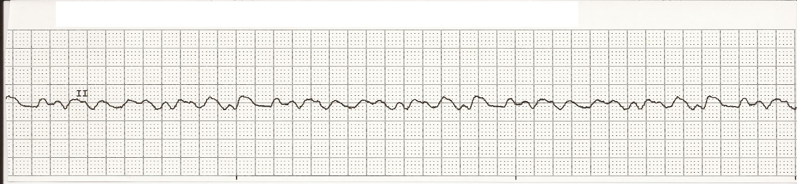 EKG Rhythm Strips 04