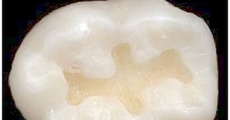 DENTÍSTICA I: Preparo Cavitário Classe I (Para Amálgama) | Prateleira ...