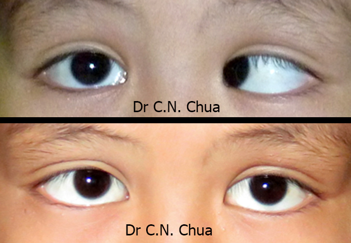 Eyelid Surgery by Prof Dr CN CHUA 蔡鐘能: Doc, Can You Straighten My Eyes ? IV