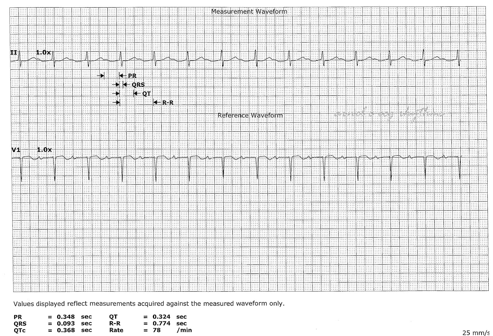 ECG Rhythms: Measurement Practice